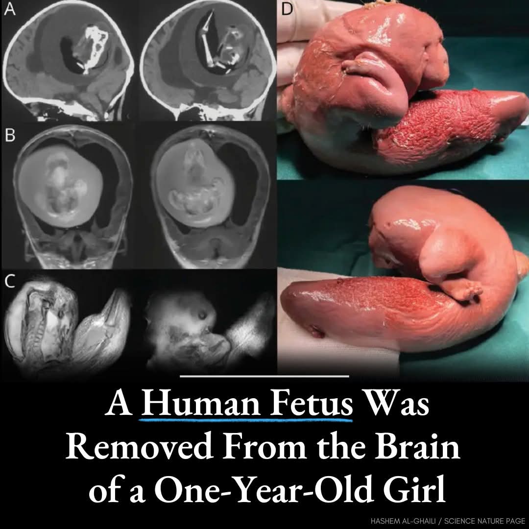 Teaching NeuroImage: Intraventricular Fetus-in-Fetu With Extensive De ...